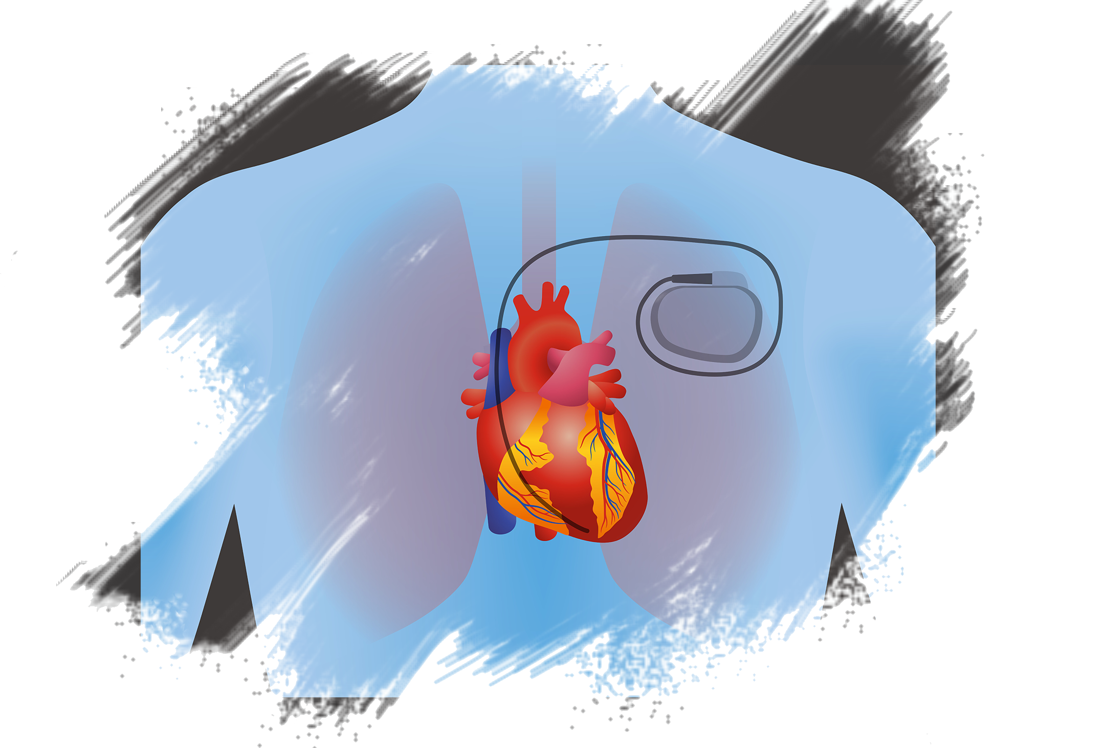 Pacemaker Implantation – NICE Sky Med by NICE Ltd